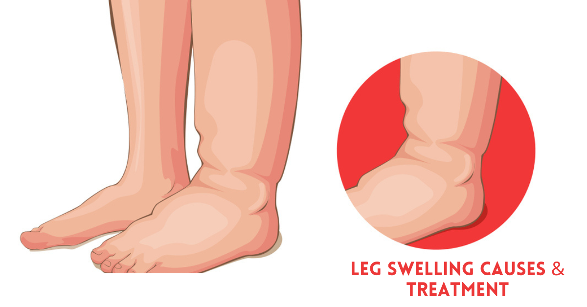 Leg Swelling: Causes & Treatment. Edema, or leg swelling, typically… | by Mahimaavarun | Medium
