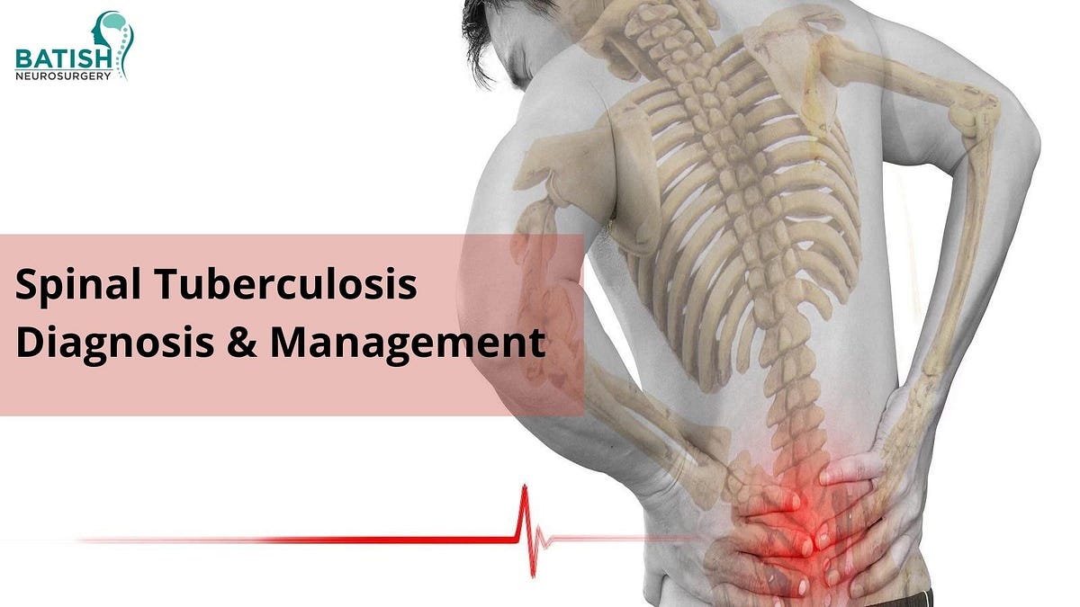 Spinal Tuberculosis: Diagnosis and Management | by Rohan Bhatt | Medium
