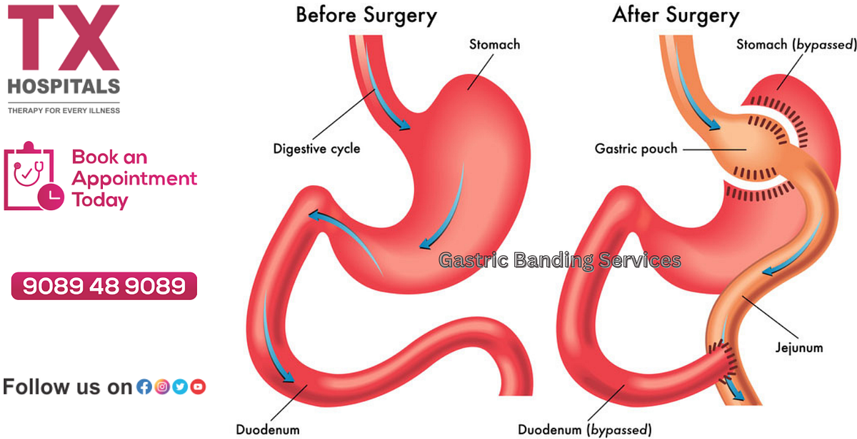 Gastric Banding Surgery in Hyderabad: A Comprehensive Guide | by ...