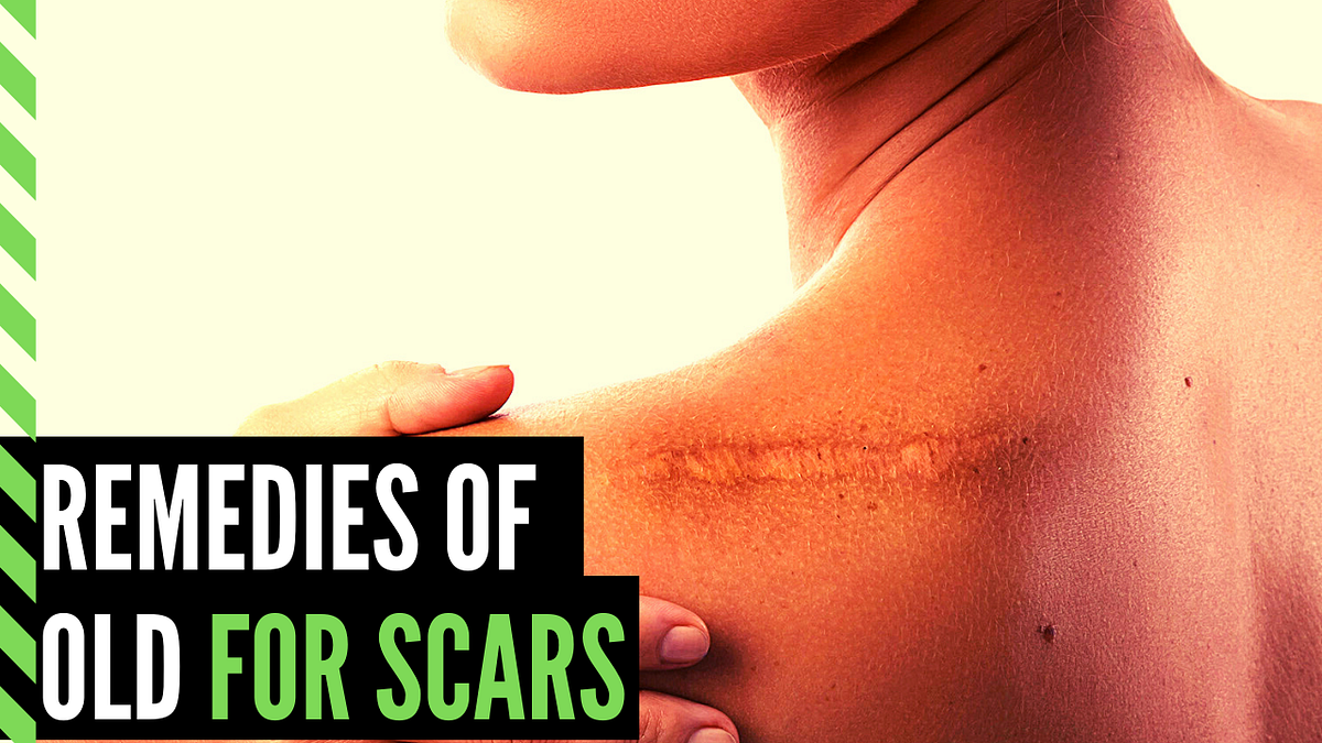 The Best Remedies of Old Scars Solutions: Get Rid of Scars Naturally ...