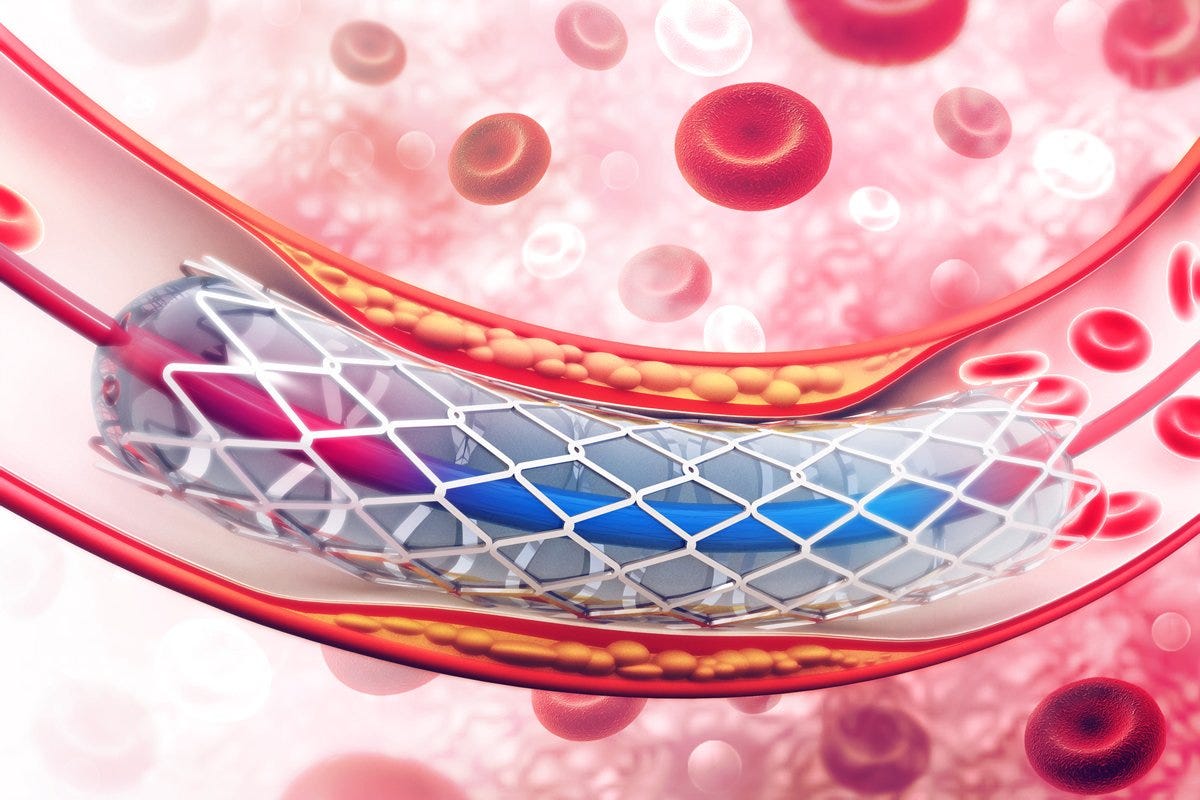 Drug Eluting Stents Market: Transforming Heart Disease Management | by ...
