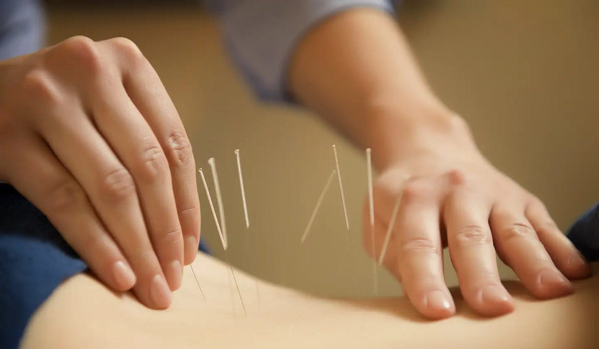 Exploring the Role Of Physiotherapists in Dry Needling: A Comprehensive Discussion | by Kavya ...
