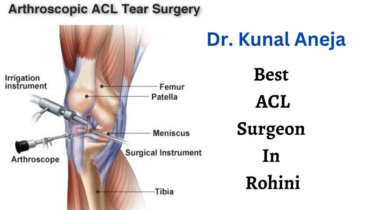 Best ACL Surgeon in Delhi: Your Guide to Expert Care | by Drkunalonlinemarketing | Dec, 2023 ...