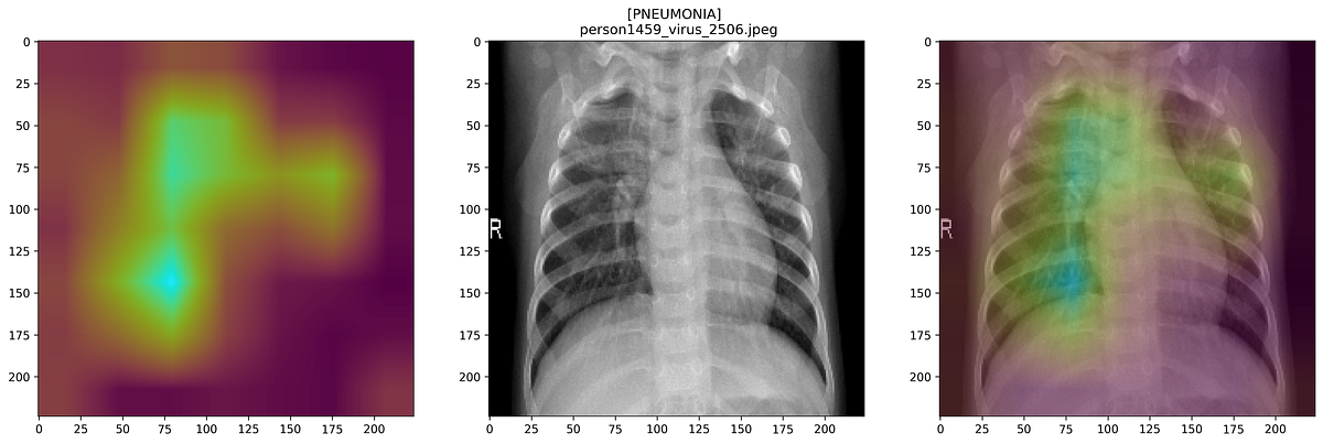 Pneumonia Detection Using Convolutional Neural Network | by Chi Bui ...