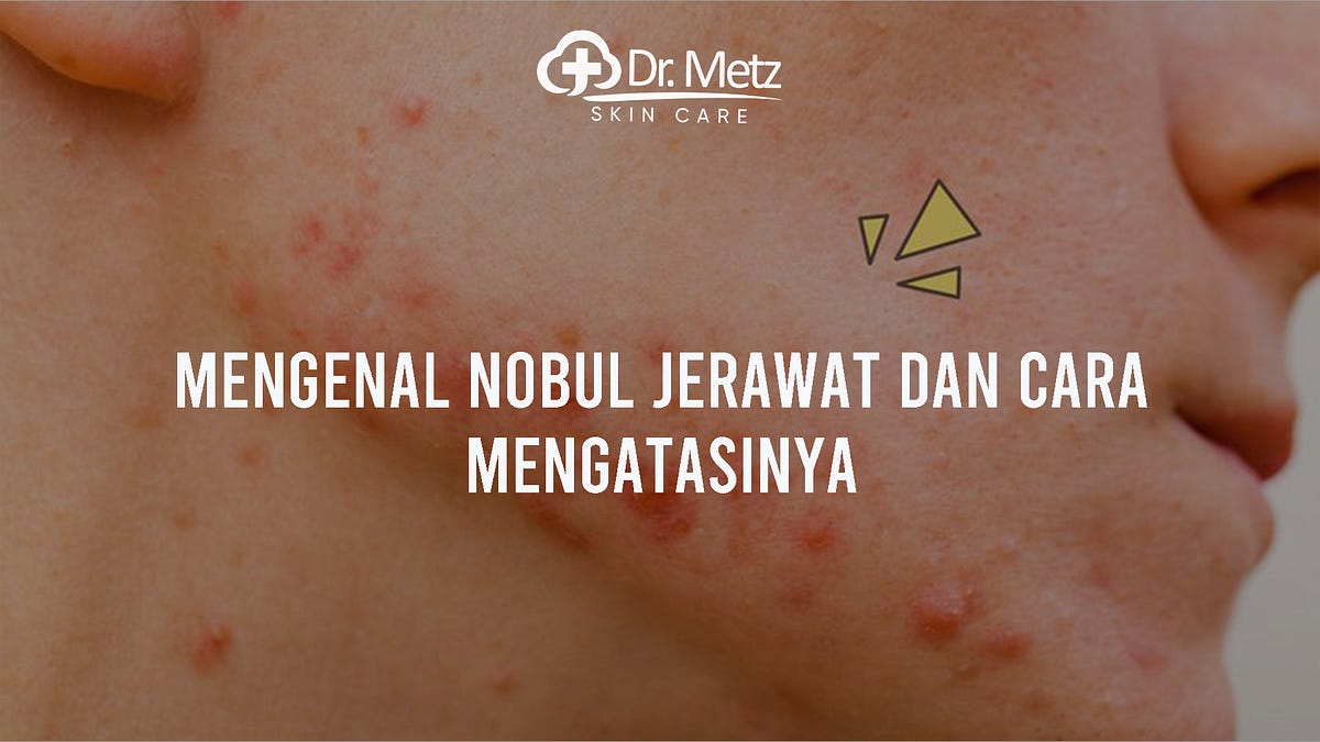 Mengenal Jerawat Nodul Dan Cara Mengatasinya | by dr metz academy | Medium
