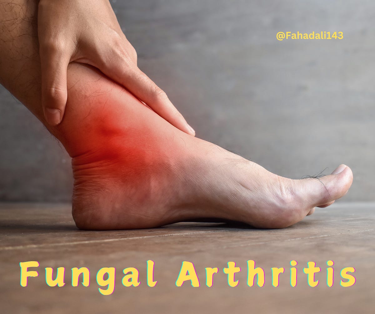 What is Fungal Arthritis: Causes, Symptoms, and Treatment Options: PART ...