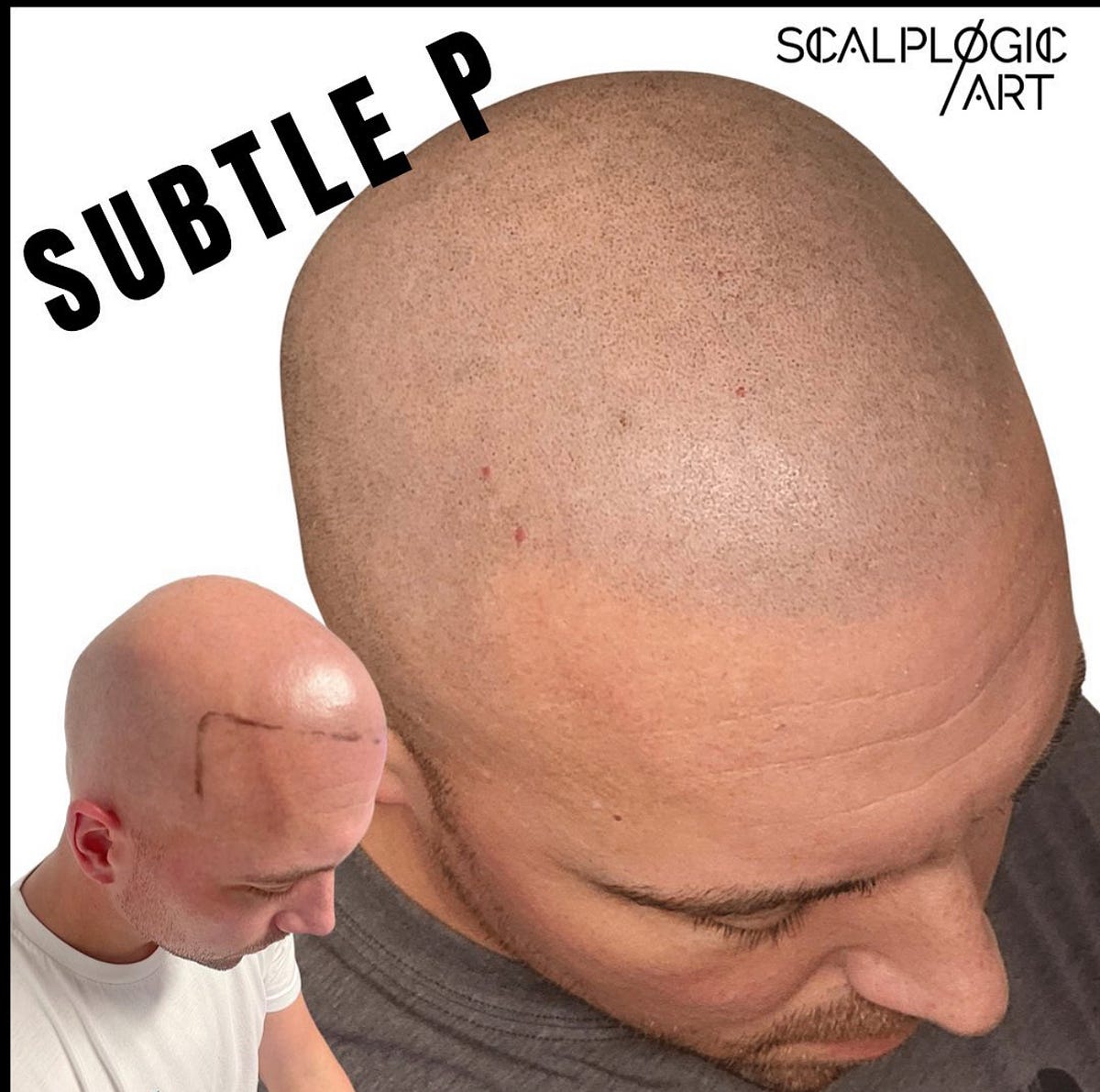 Scalp Micropigmentation or Subtle P? Scalp Micro Pigmentation is an art ...