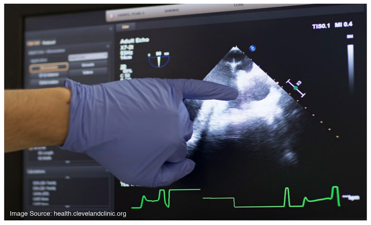 Echocardiogram: How Do You Know If You Need an Echo Test? | by Dr ...