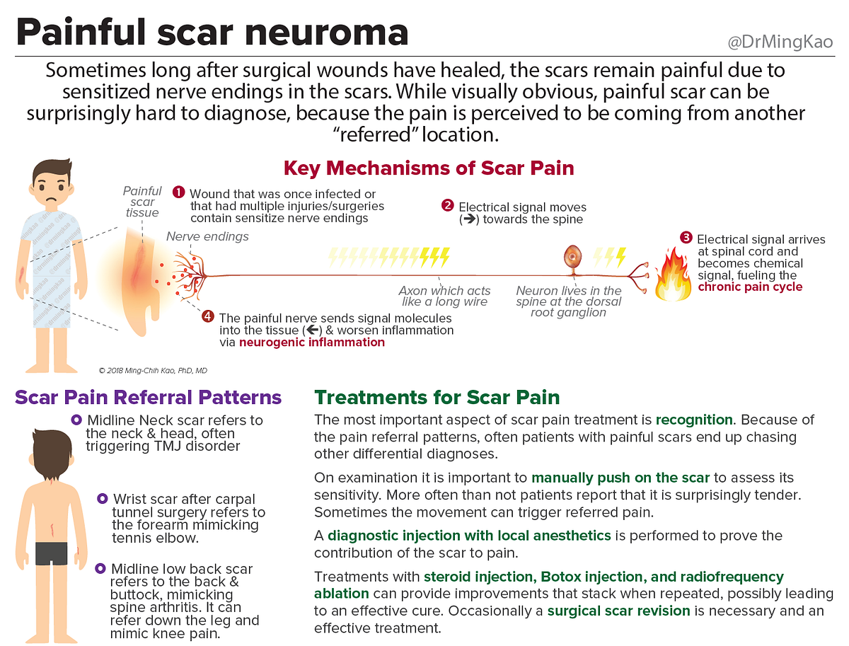 Painful scar neuroma. Sometimes long after surgical wounds… | by Dr ...