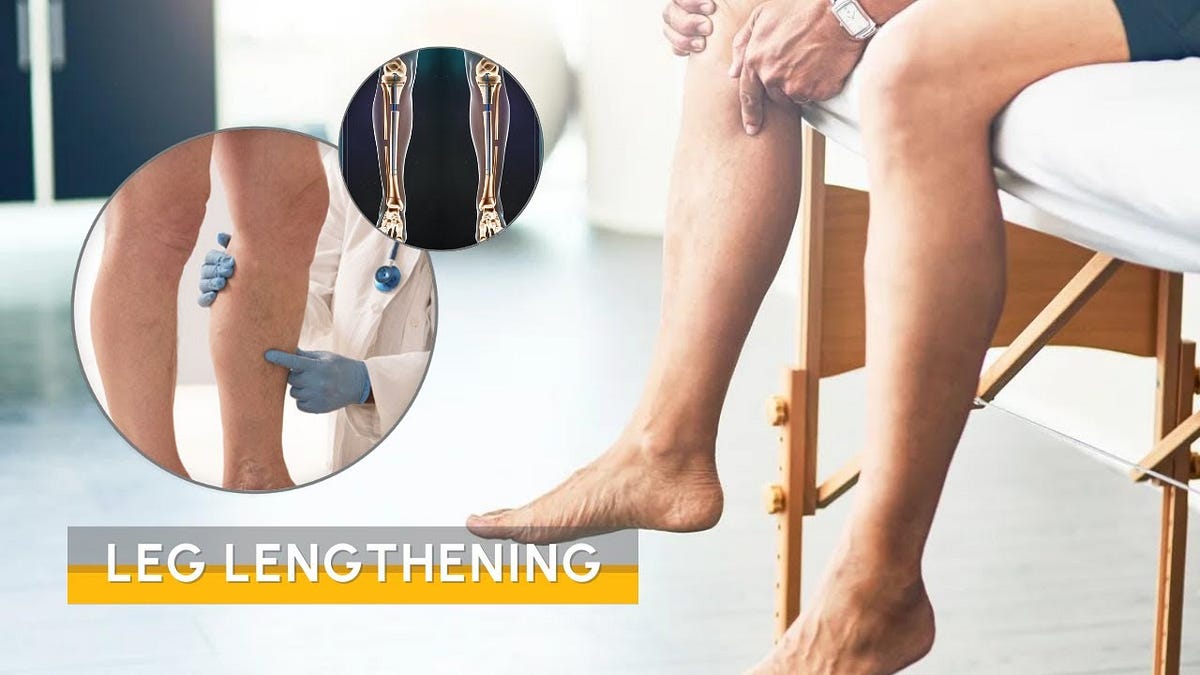 Limb lengthening Surgery history, evolution, complications and current ...