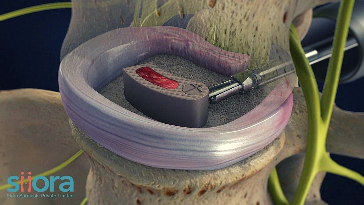 Transforaminal Lumbar Interbody Fusion (TLIF) — Diagnosis & Treatment ...