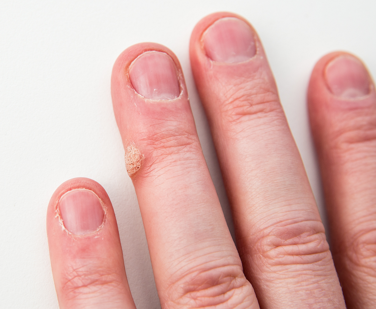 Warts and All: Myths and Misconceptions about Warts | by Annie Foley ...