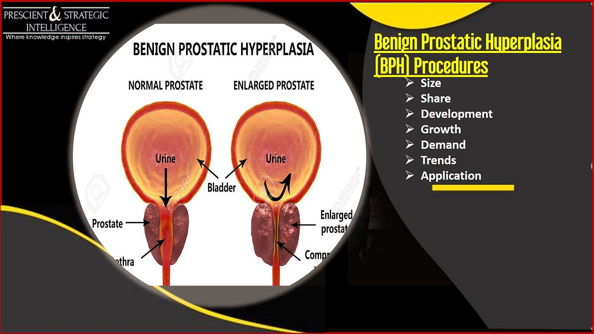 Benign Prostatic Hyperplasia (BPH) Procedures Explores New Growth Opportunities | by Pramod ...