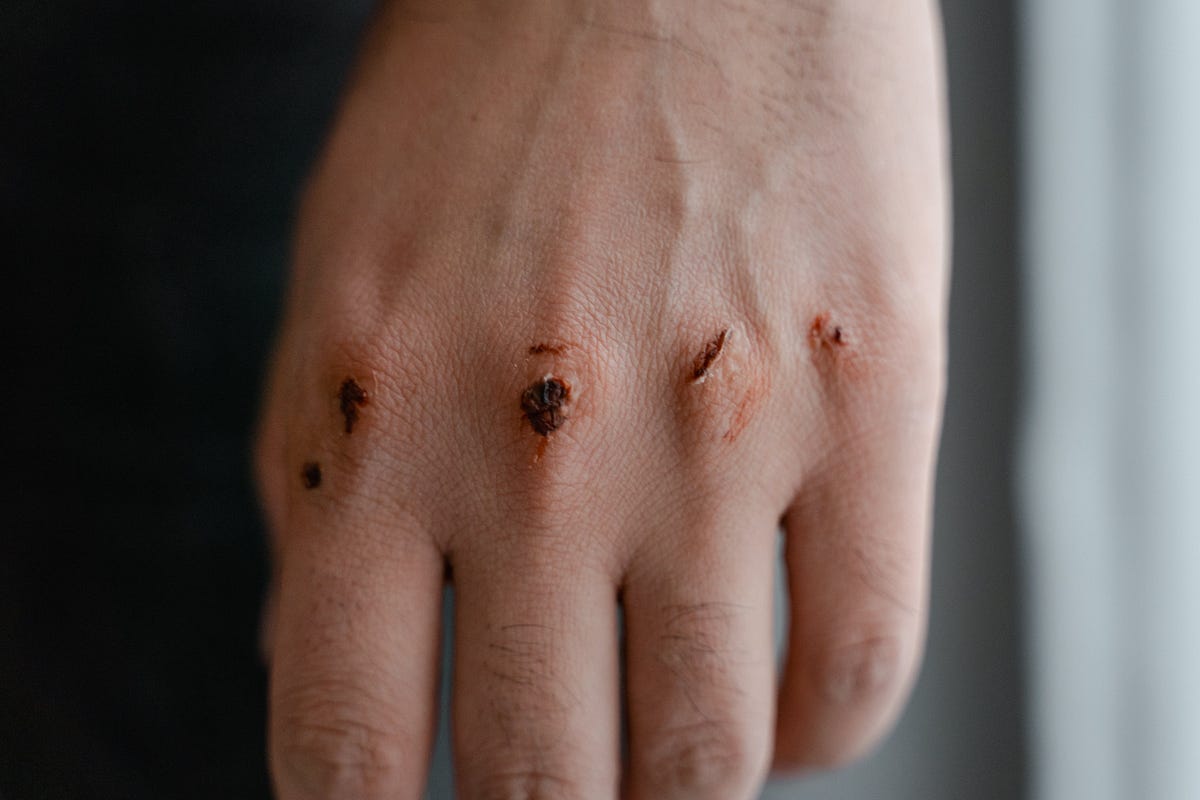 Do scars also create bond?. “We are on the same boat.” | by Arif ...