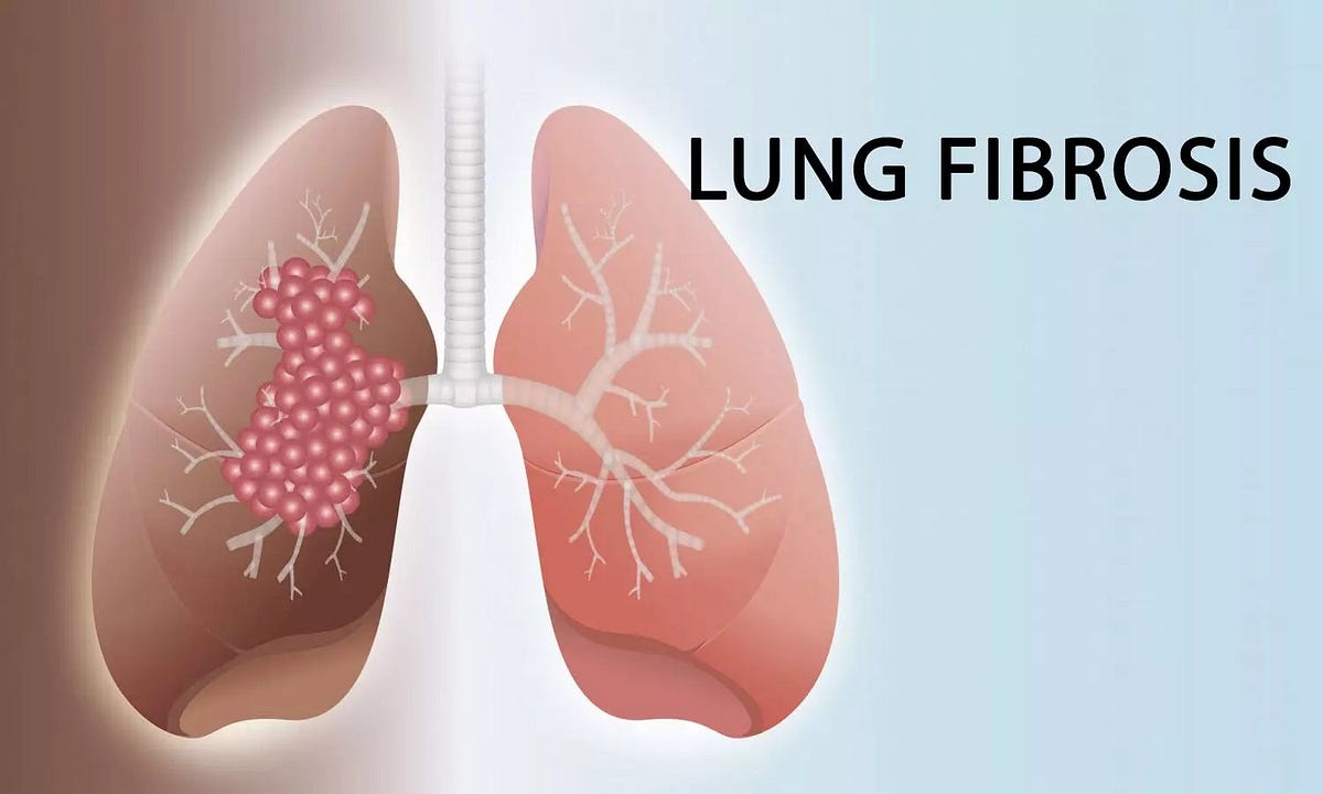 What are the common symptoms of lung fibrosis? | by Sparshclinic | Oct ...