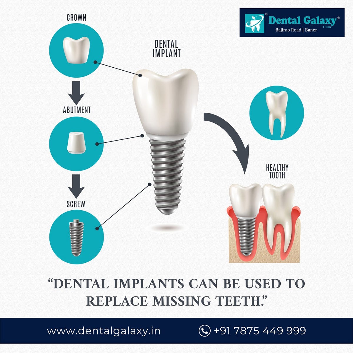Dental Implants Can Be Used to Replace Missing Teeth - Dental Galaxy ...