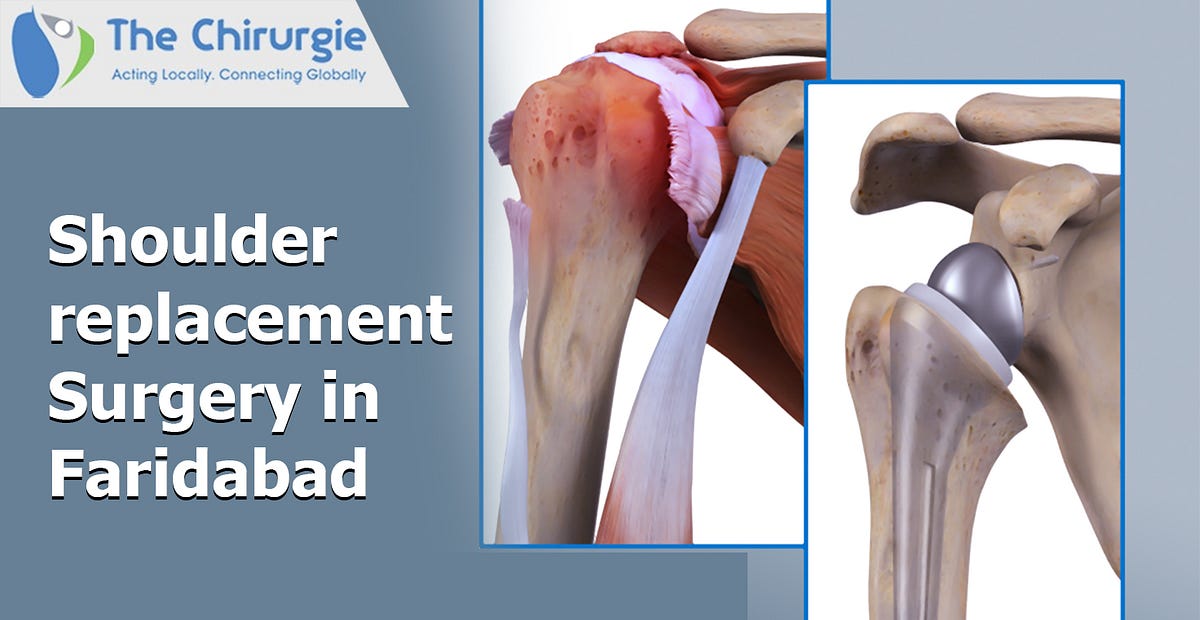Shoulder replacement Surgery in Faridabad | by Thechirurgie0 | Medium