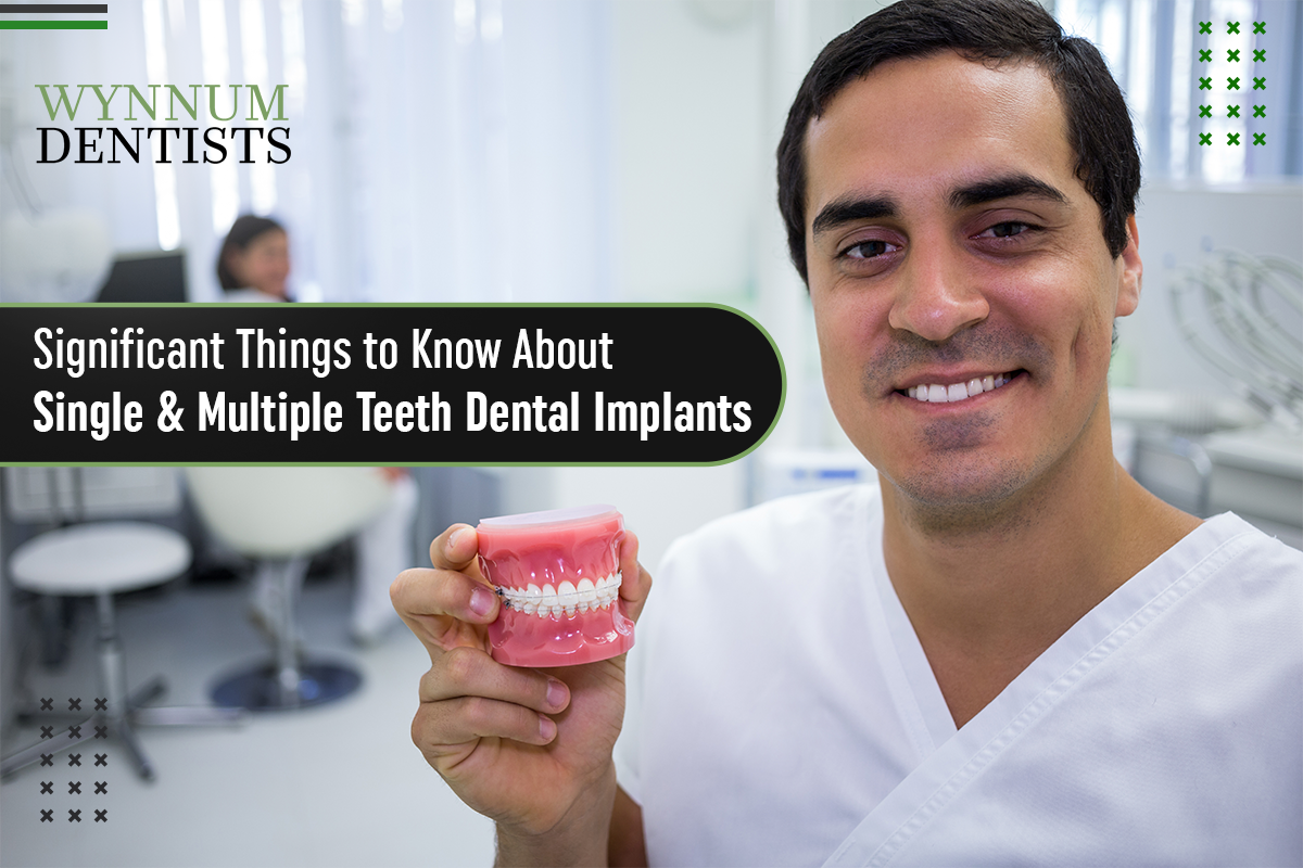 Significant Things to Know About Single and Multiple Teeth Dental Implants | by Wynnum Dentists ...