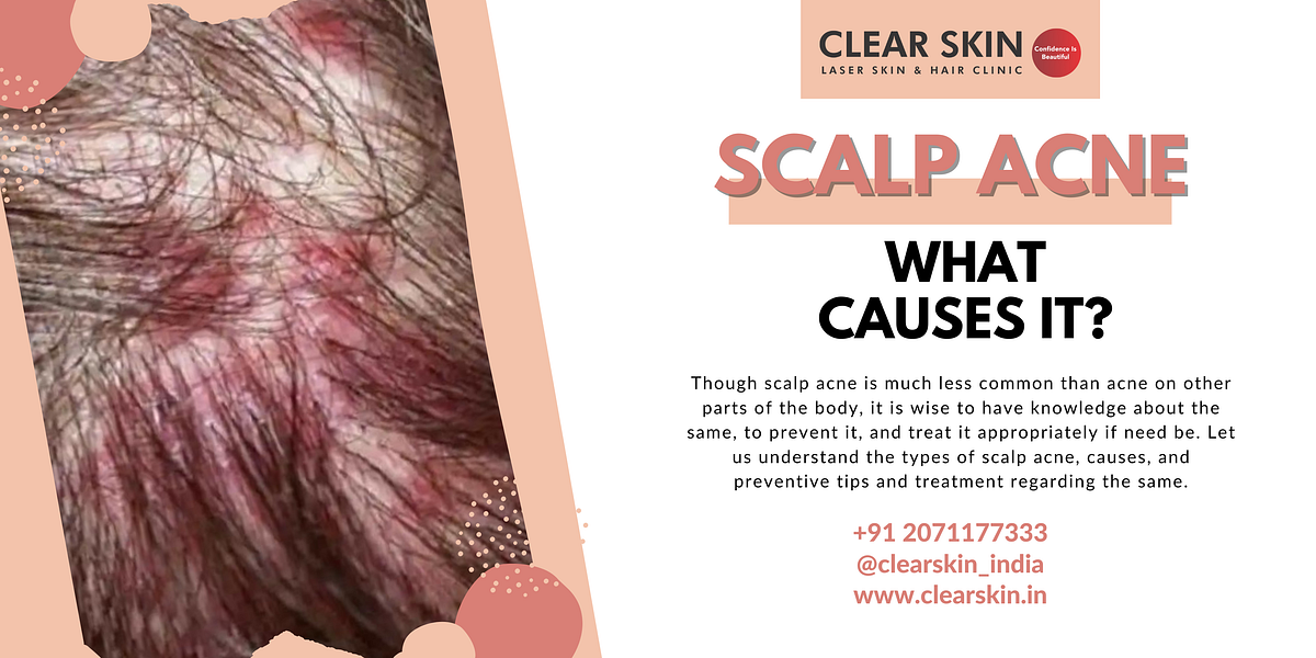 What Causes Scalp Acne And Hair Loss at Laura Stanley blog