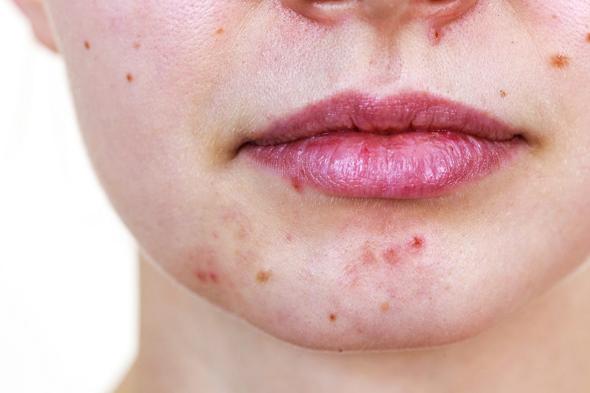 Understanding Acne Face Map: Myth or Insight into Your Health? | by ...