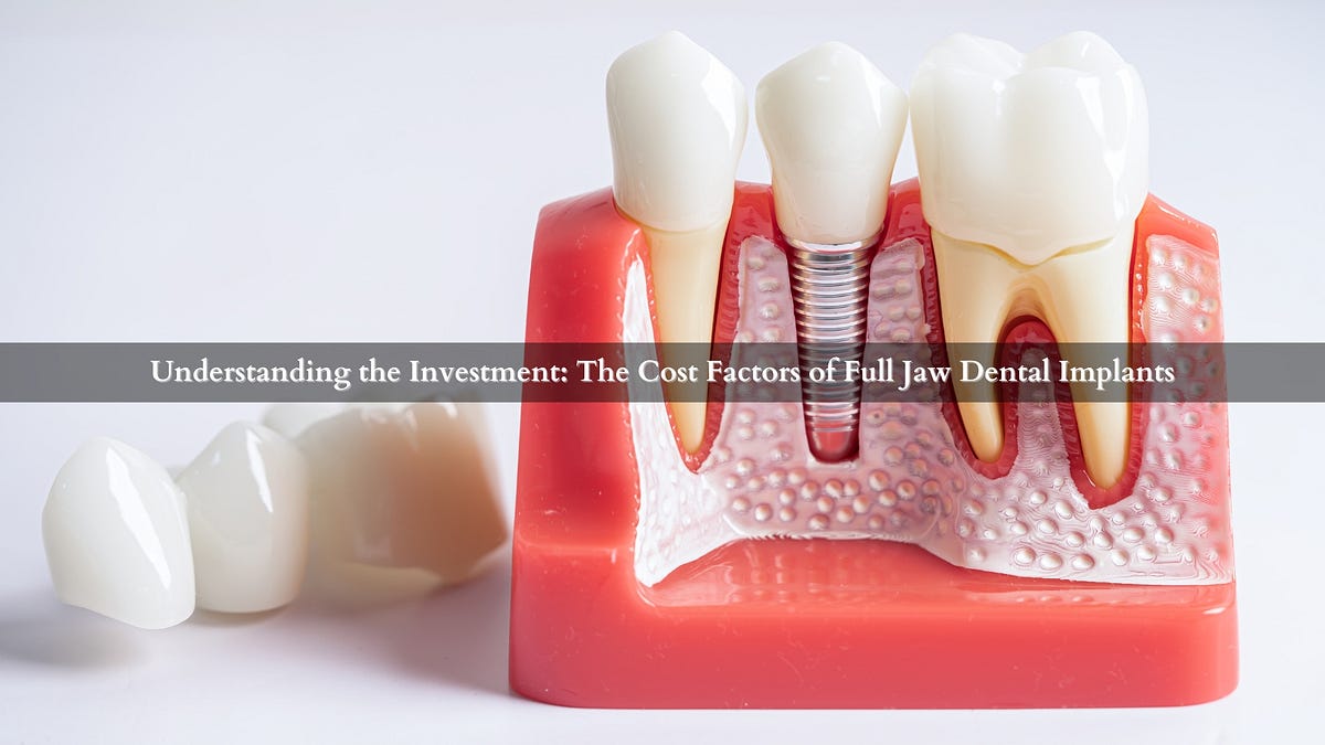 Understanding the Investment: The Cost Factors of Full Jaw Dental ...