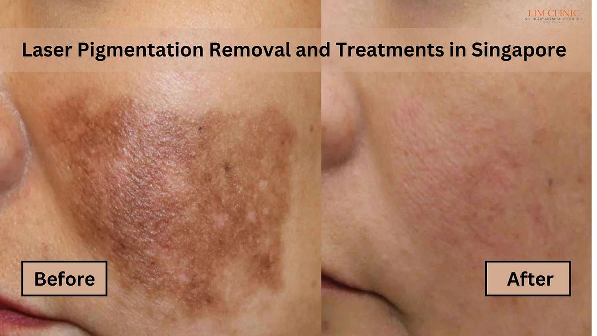 Why Choose Lim Clinic and Surgery for Laser Pigmentation Removal in ...