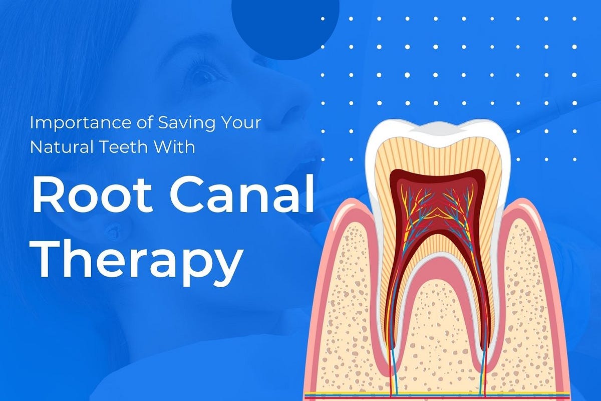 Signs Indicating the Need for Painless Root Canal Treatment in Delhi ...