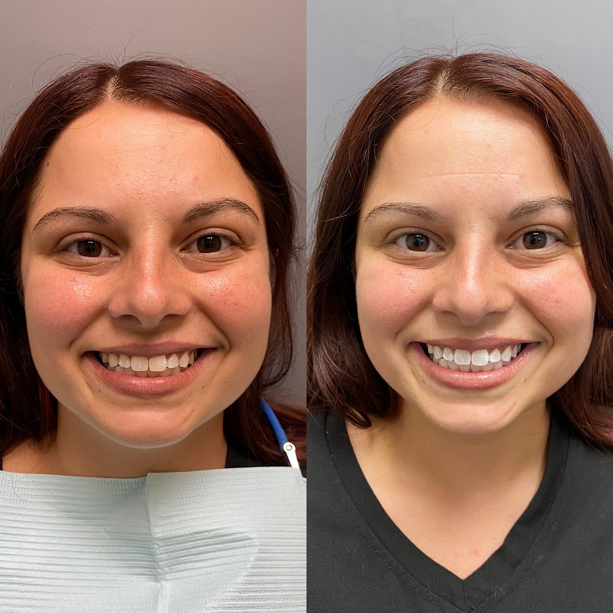 Achieving A Brighter Smile Fast And Easy Teeth Whitening Tips By