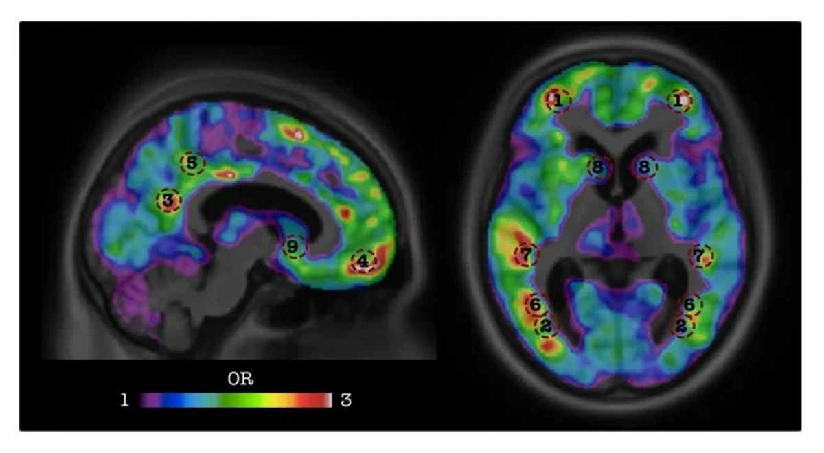 Automatic Dementia Screening And Scoring Sowhardh Honnappa Medium