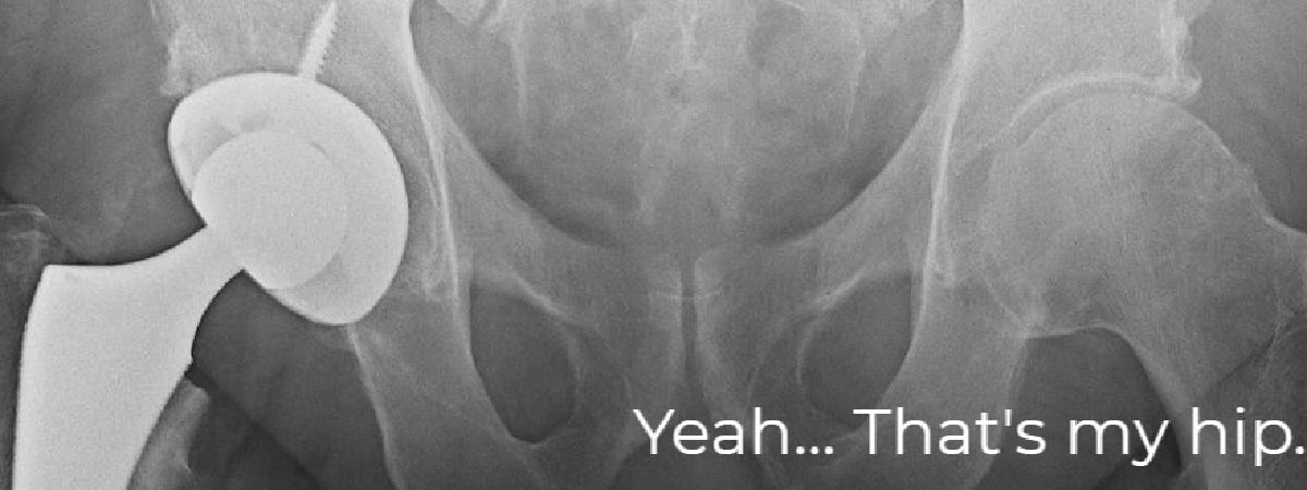 How Do You Know You Need A Hip Replacement? 36 Tests… Tests 1–12 | by ...