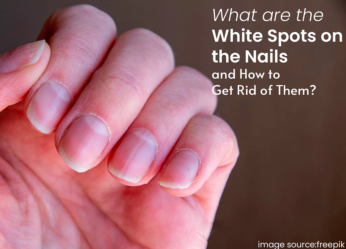 What are the White Spots on the Nails and How to Get Rid of Them? | by ...