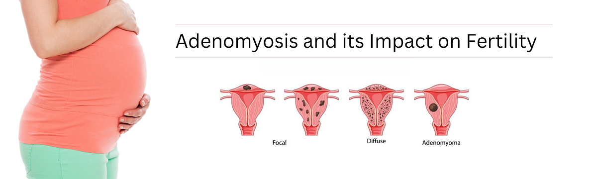Adenomyosis and its Impact on Fertility - Gaudium IVF - Medium