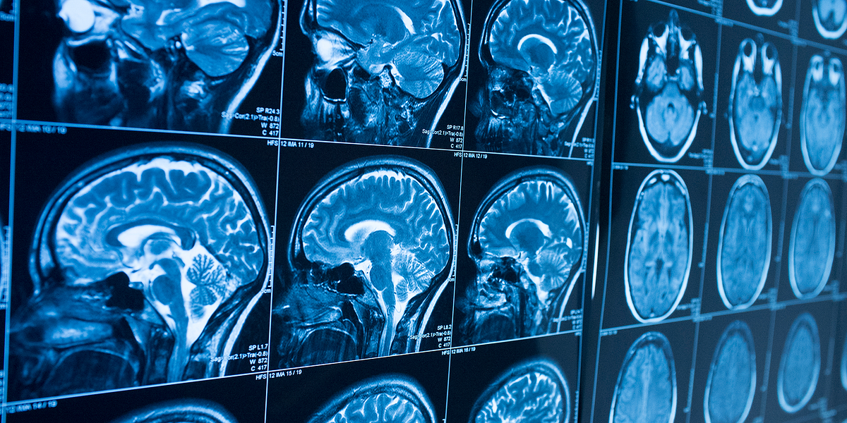 How Alzheimer’s disease is diagnosed | by Dr. Nathan Herrmann | The ...