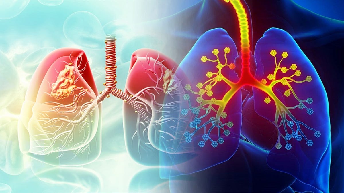 What kind of asthma is there? | What are the different types of asthma? | Medium