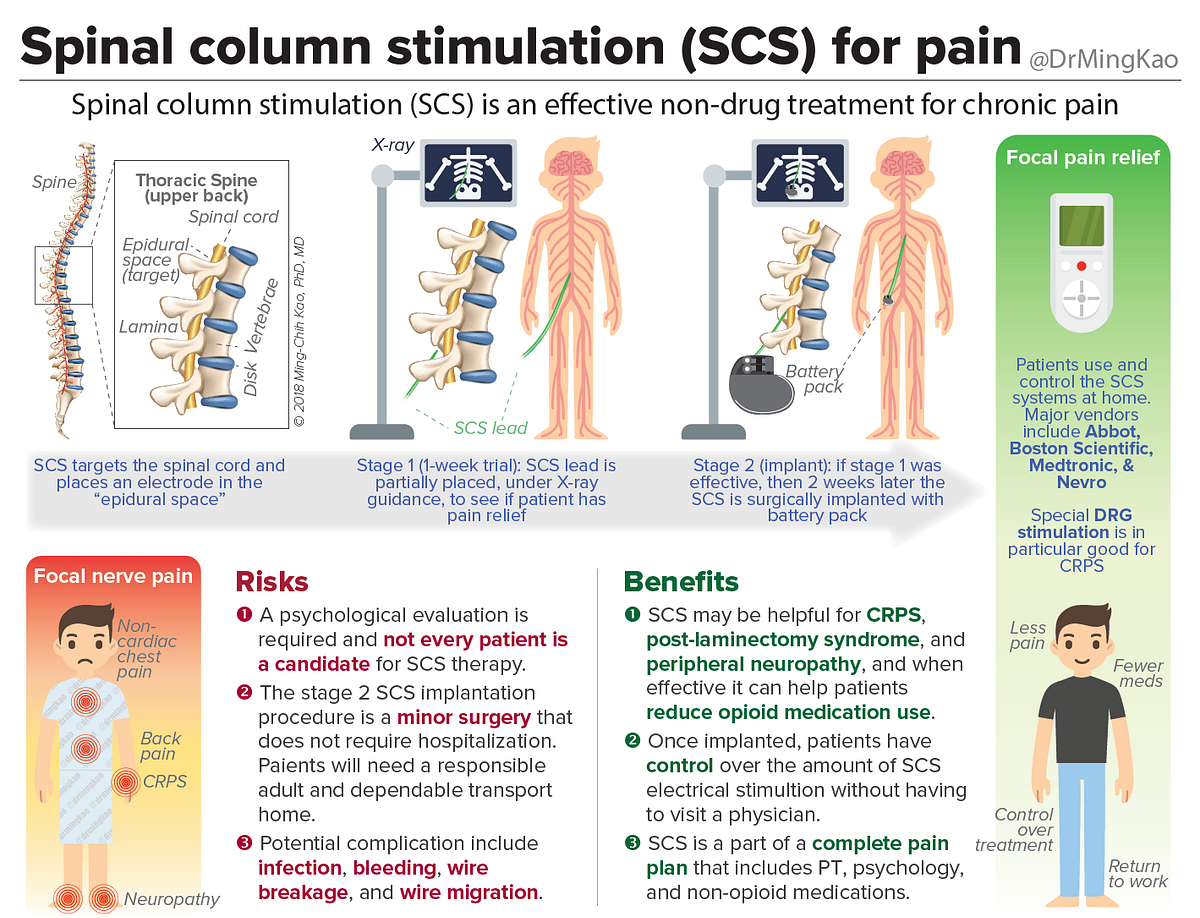 Spinal column stimulation (SCS) for the treatment of chronic pain | by ...