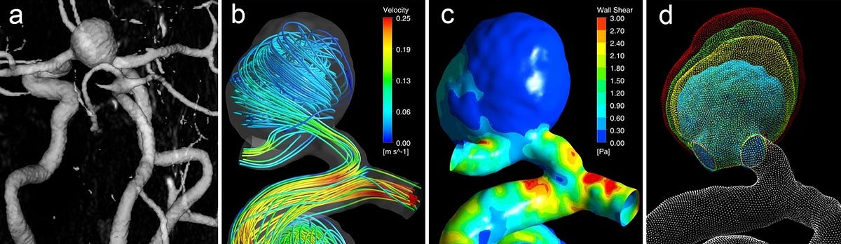 Image-based blood flow modeling to lessen invasive treatment | by ...