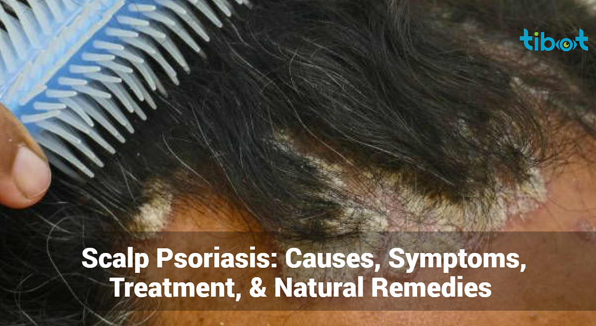 Scalp Psoriasis: Causes, Symptoms, Treatment, Remedies | by Eczemaless ...