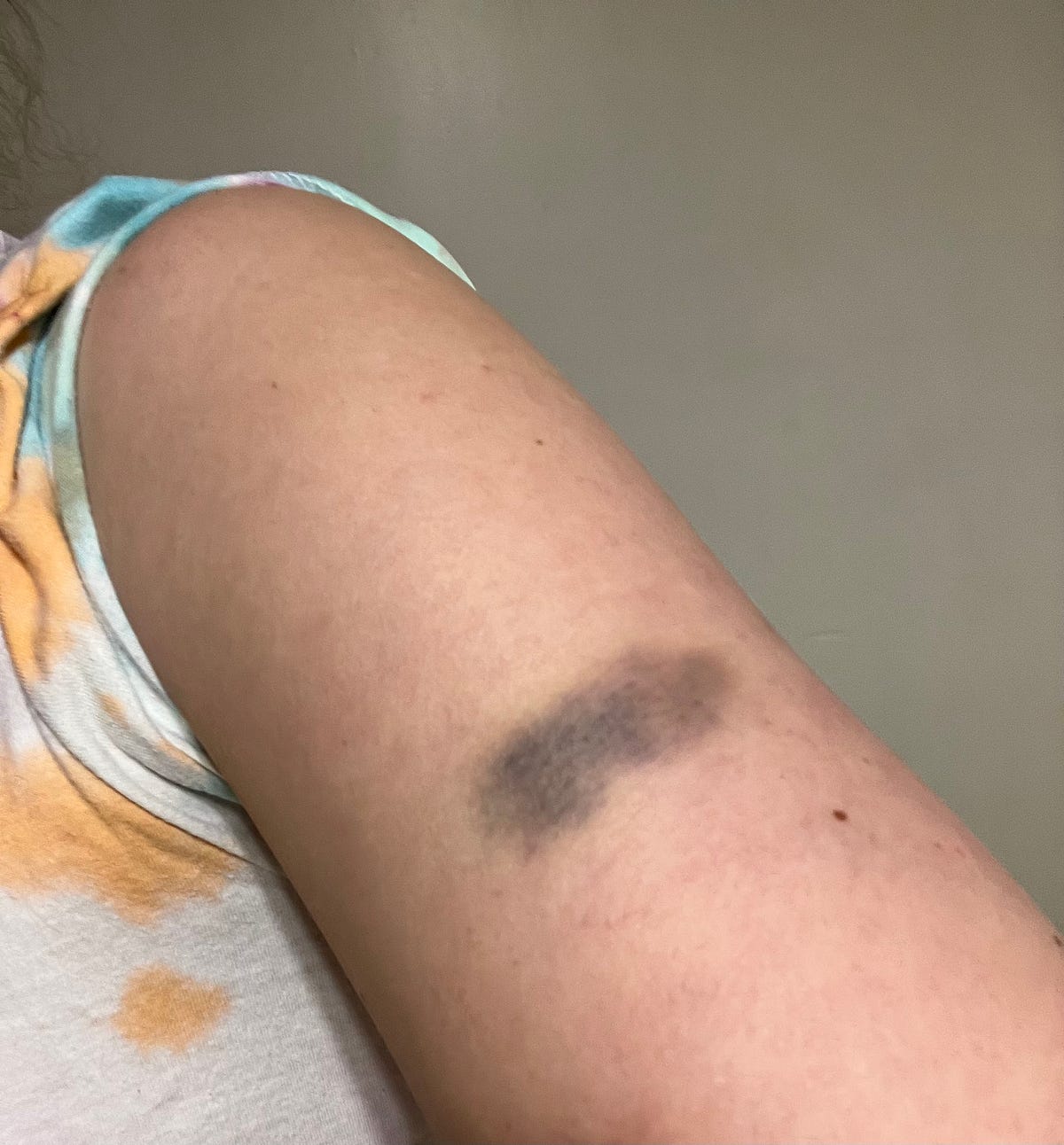 Physical Marks. He grabbed my shoulder and twisted… | by Summer O׳Toole ...