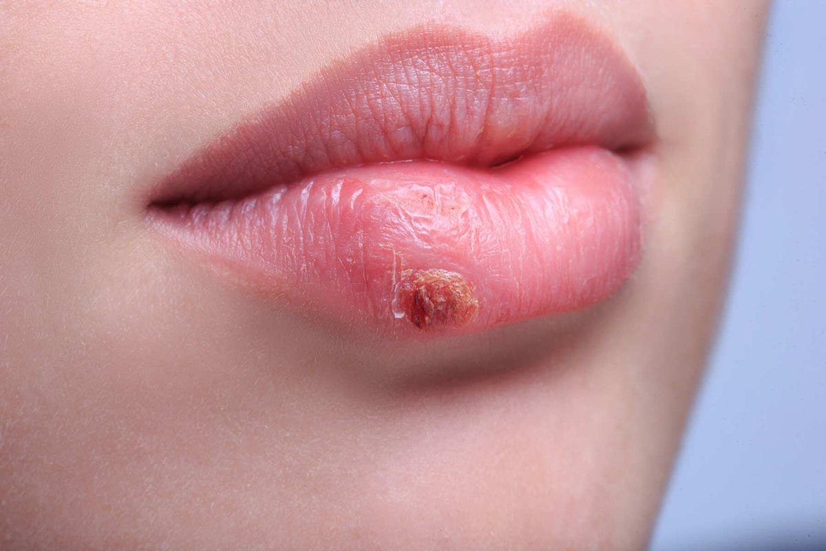 Understanding Cold Sores or “Fever Blisters” : Exploring Nutritional ...