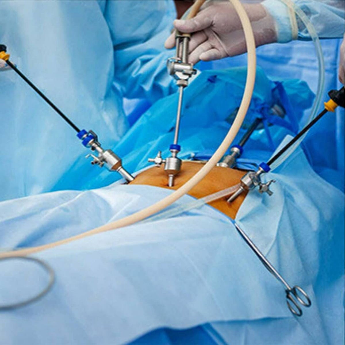 How is an abdominal laparoscopy performed? | by shimist shimist | Medium