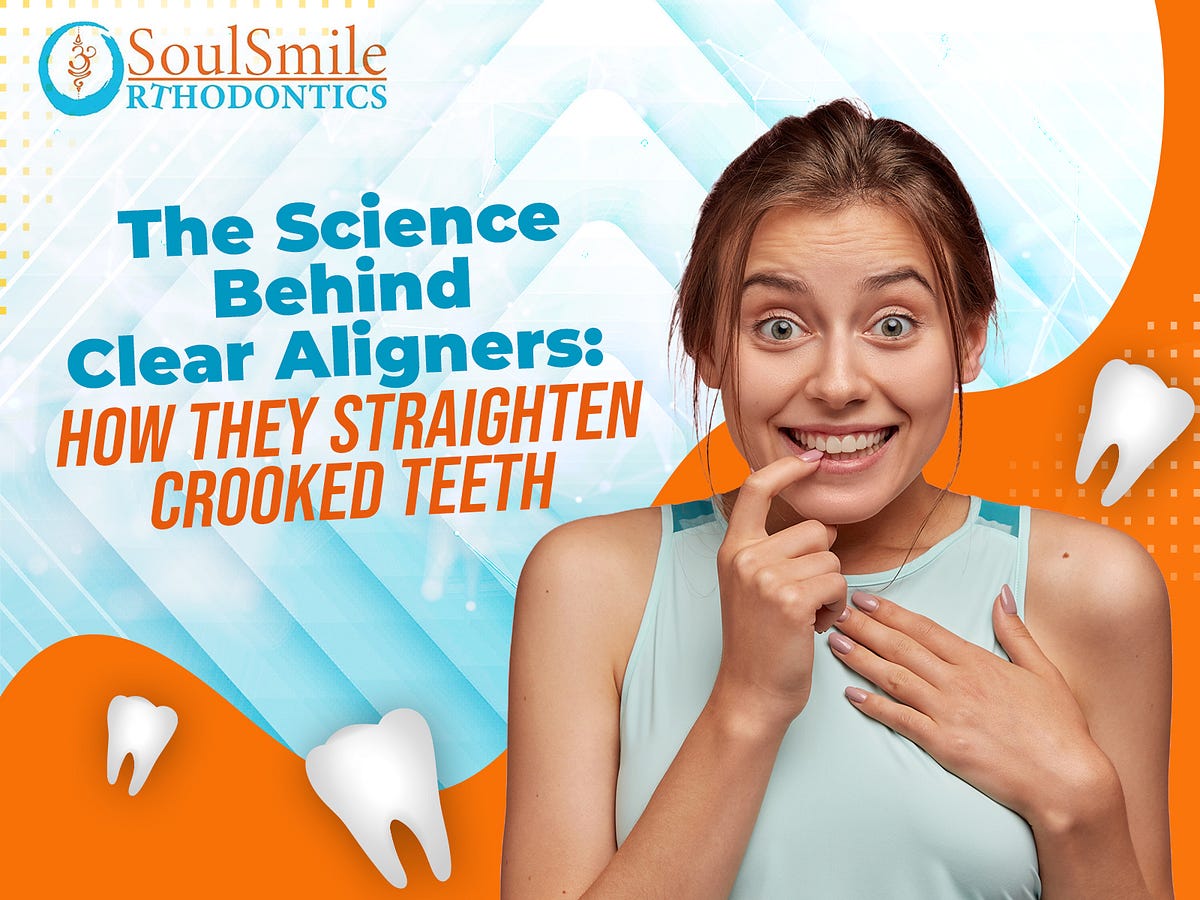 The Science Behind Clear Aligners: How They Straighten Crooked Teeth | by SoulSmile Orthodontics ...