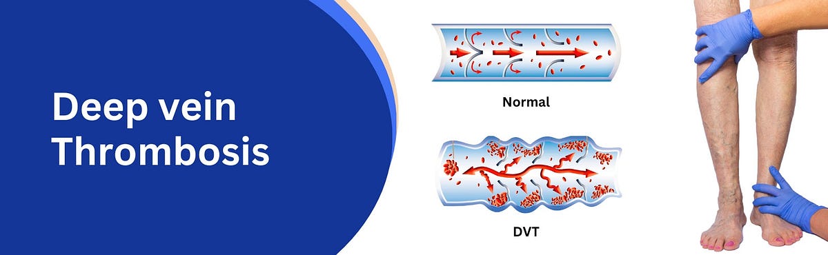 Deep Vein Thrombosis. Deep Vein Thrombosis: Understanding the… | by ...