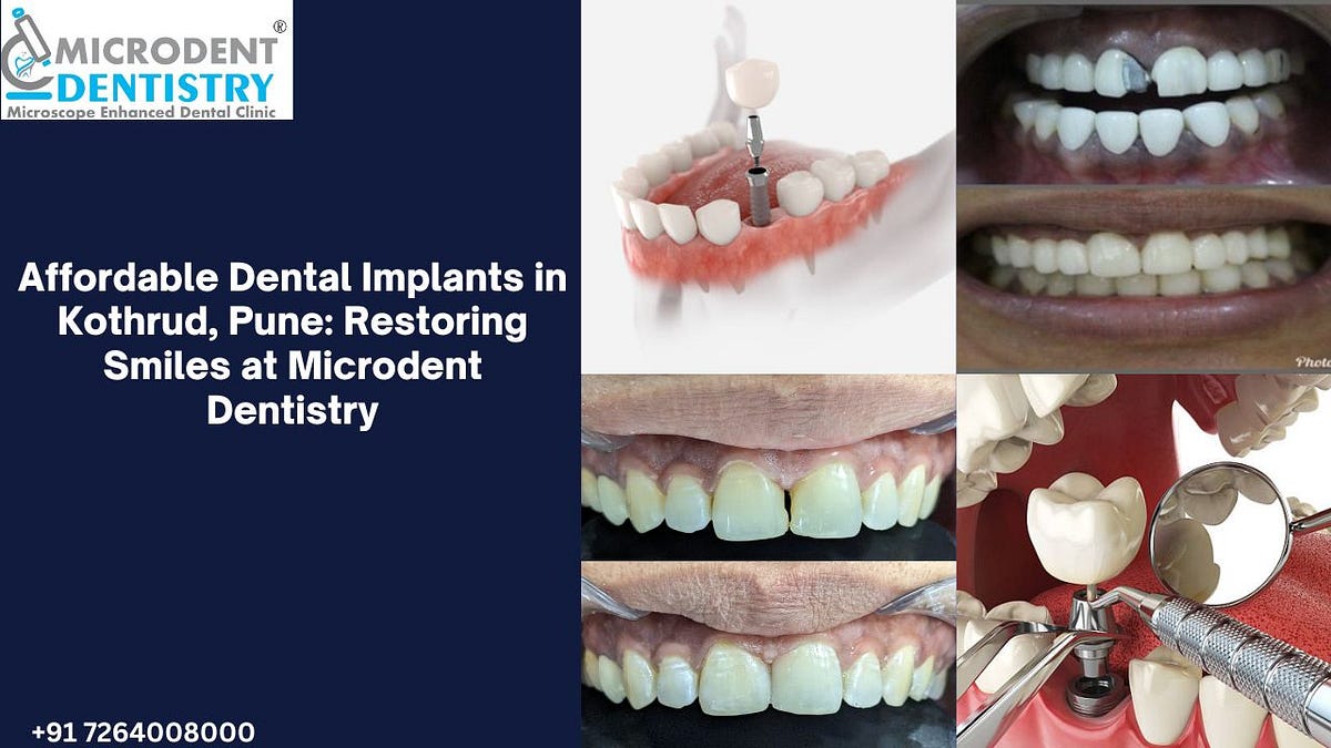 Affordable Dental Implants in Kothrud, Pune: Restoring Smiles at Microdent Dentistry | by ...