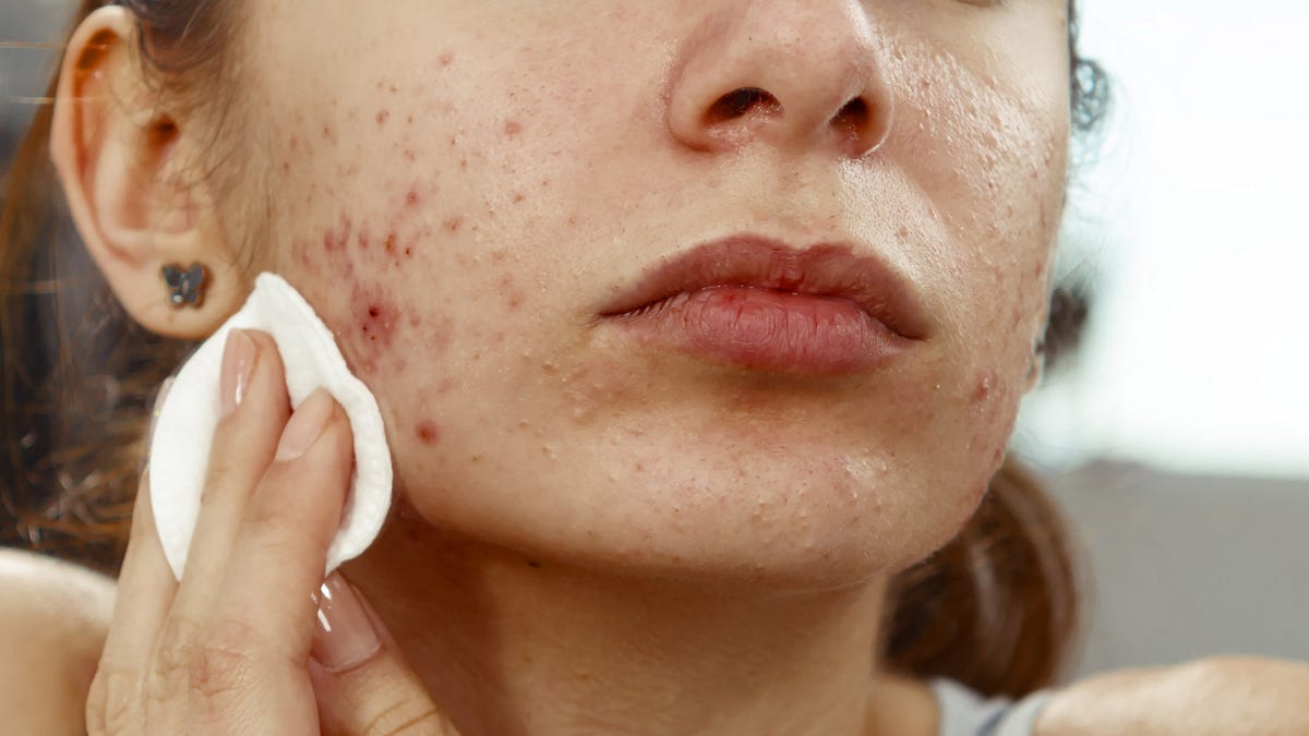 Diving Into Clear Skin The Salt Water Acne Solution | by Healty Skin ...
