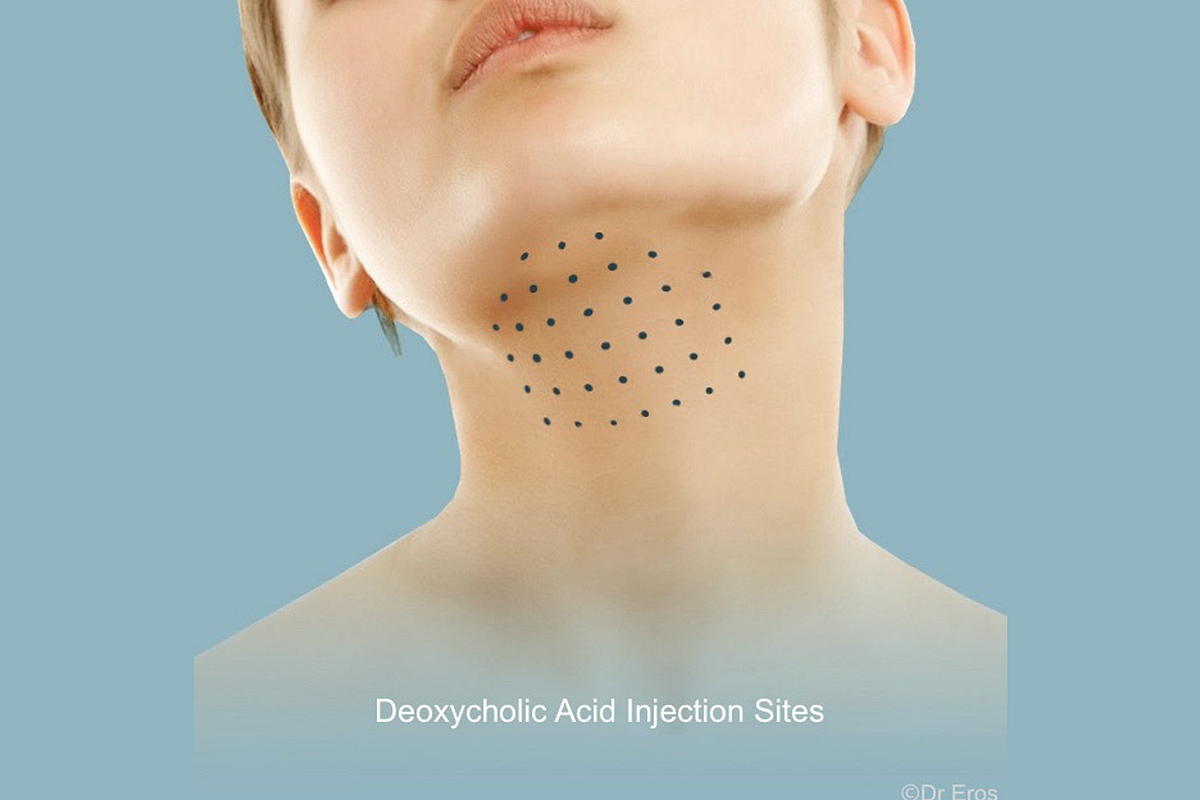 Kybella (Belkyra) in Toronto. Kybella (Belkyra)/ | by lip doctor | Medium