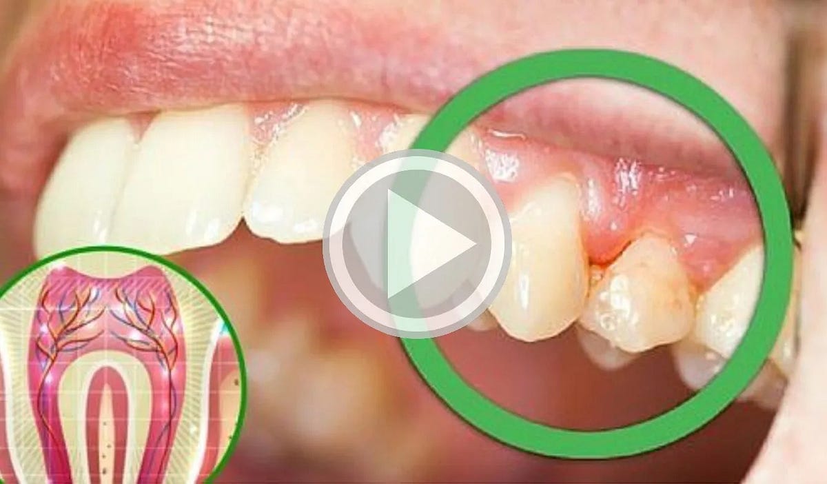Damaged Gums? This Life-Threatening Bacteria Eats Your Teeth ...