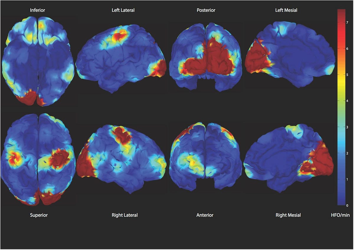 BCI and AI applications in Epilepsy care, intracranial EEG, and ...