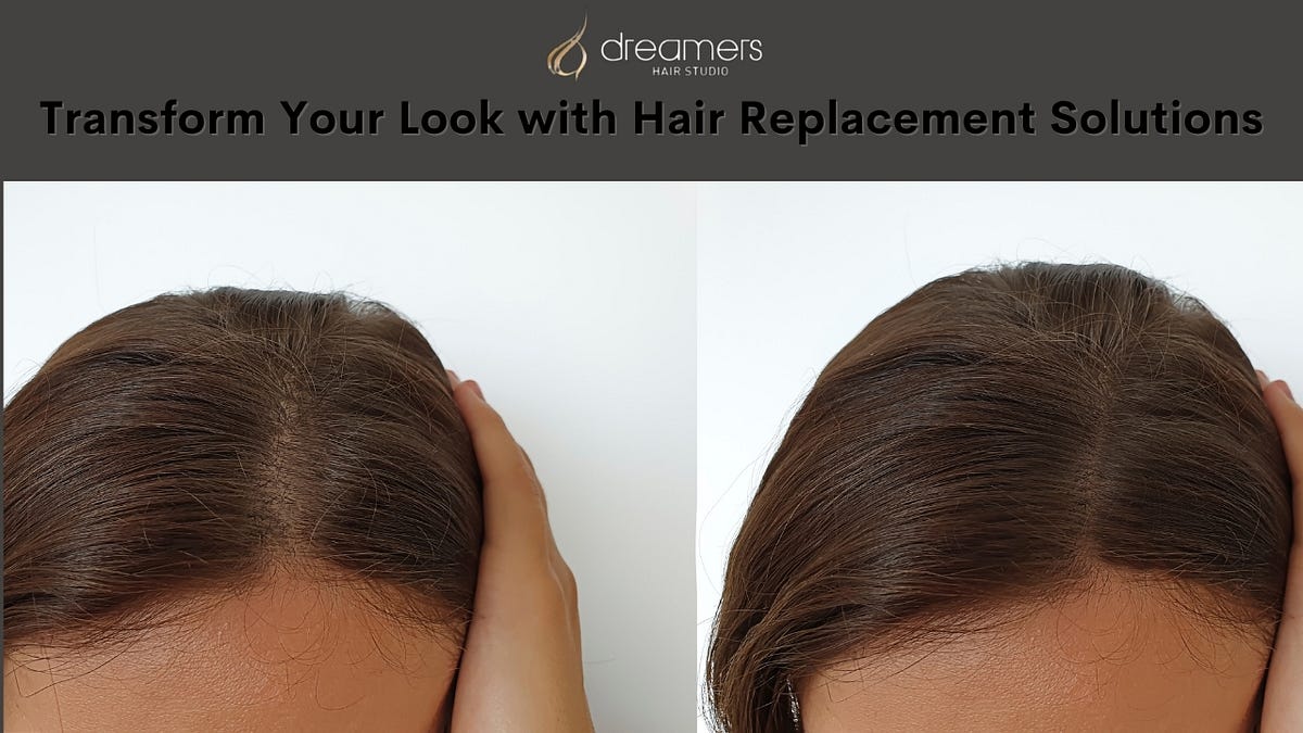 Revolutionizing Hair Replacement in Chandigarh and Mohali | by Dreamers ...
