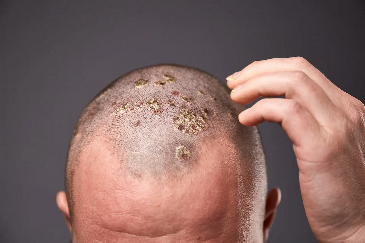 Seborrheic Keratosis Common Skin Growth Explained By Health And