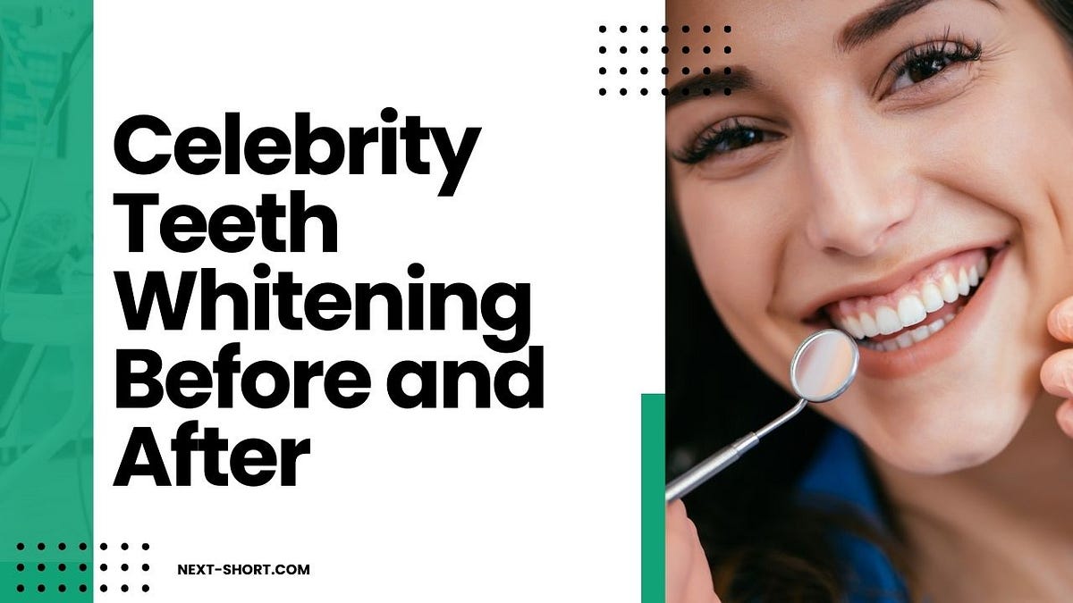 Celebrity Teeth Whitening Before and After | by Nathan Cook | Jul, 2024 ...